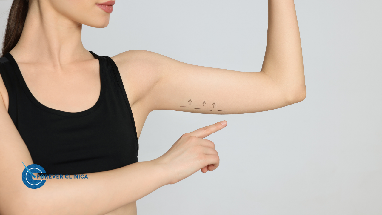 Everything You Need to Know About Arm Lift Surgery - Forever Clinica